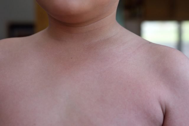 Ringelflechte: Ursachen, Symptome und Behandlung - rundumgesund.de