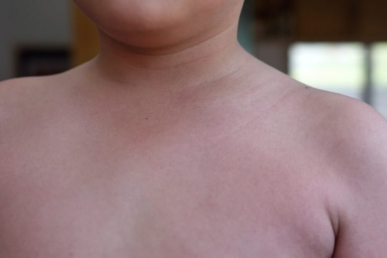 Ringelflechte: Ursachen, Symptome und Behandlung - rundumgesund.de