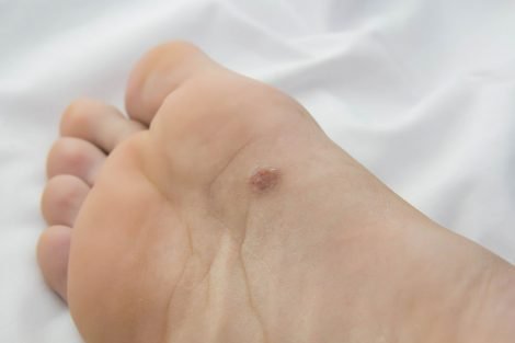 Dellwarzen: Ursachen, Symptome und Behandlung - rundumgesund.de