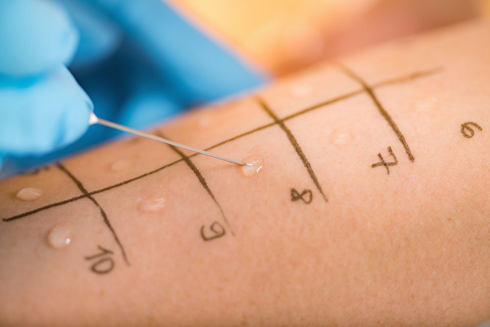 Prick Test Was Ist Das Und Wozu Dient Er Rundumgesund De